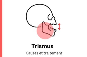 Le trismus ou trisme : ce qu'il faut savoir | Medespoir dentaire